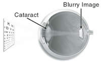 Test your knowledge: What do you really know about cataracts ...