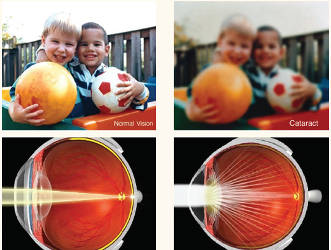 normal-vision-vs-cataracts-illustration-examples